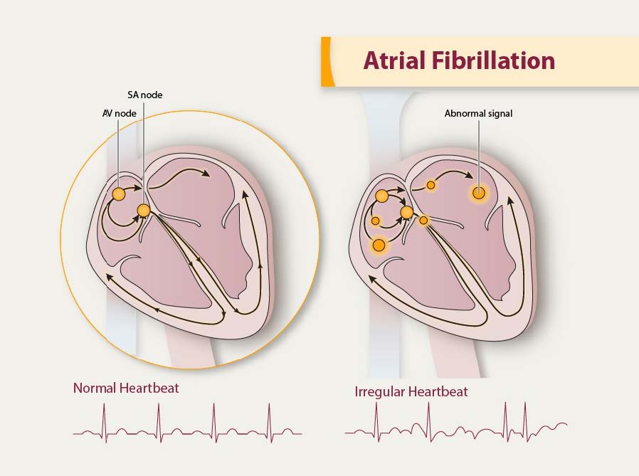 Atrial Fibrillation Awareness Month | Sacred Journey Hospice